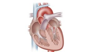 Mitral Stenosis: Causes, Symptoms, & Advanced Treatment Options