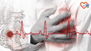 Life Expectancy After Bypass Surgery: A Comprehensive Guide