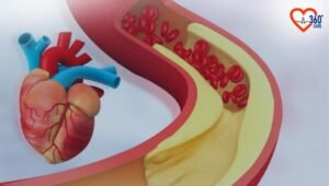 How To Check Heart Blockage Without Angiography | Expert Guide